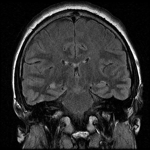 Temporal Lobe Epilepsy (TLE) | Epilepsy Foundation