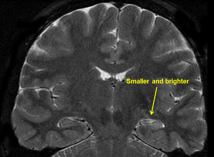 Temporal Lobe Epilepsy (TLE) | Epilepsy Foundation